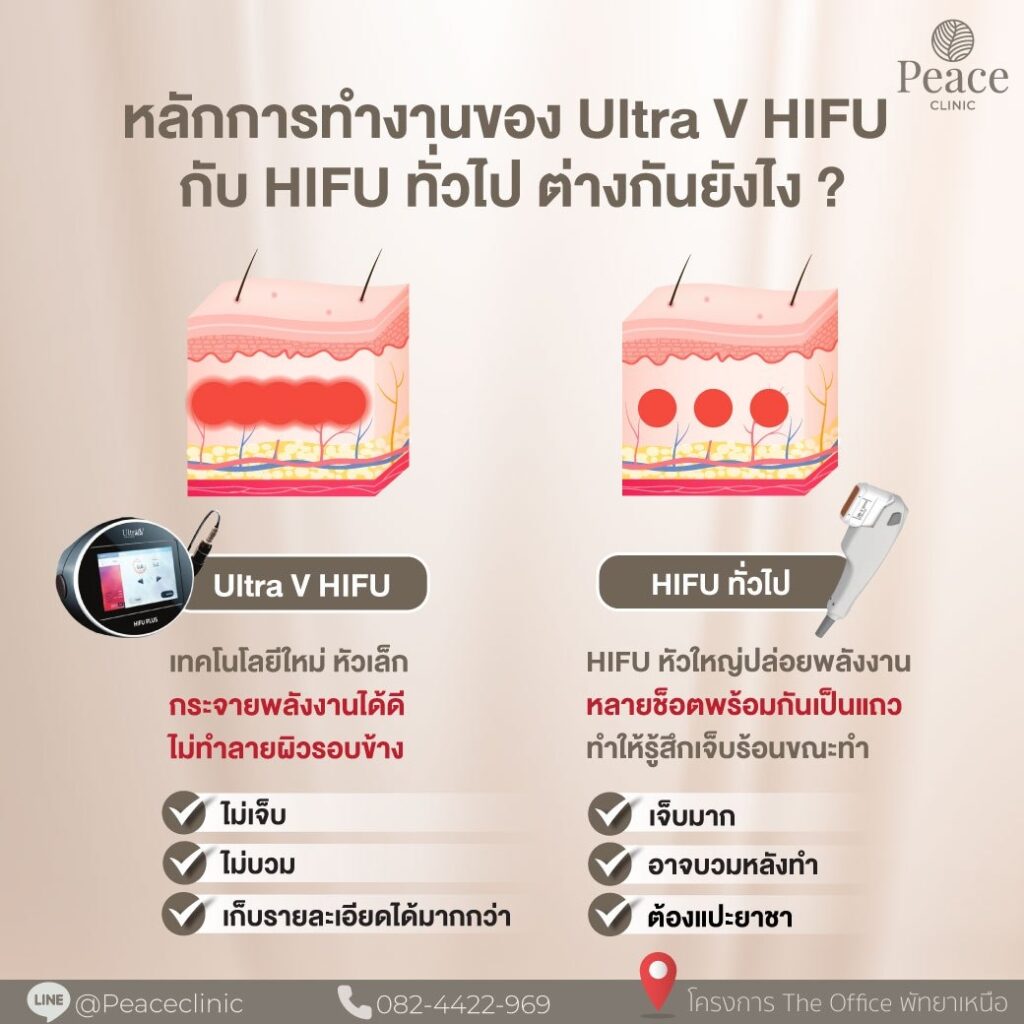 Non-invasive Facelift with Ultra V HIFU - Peace Clinic