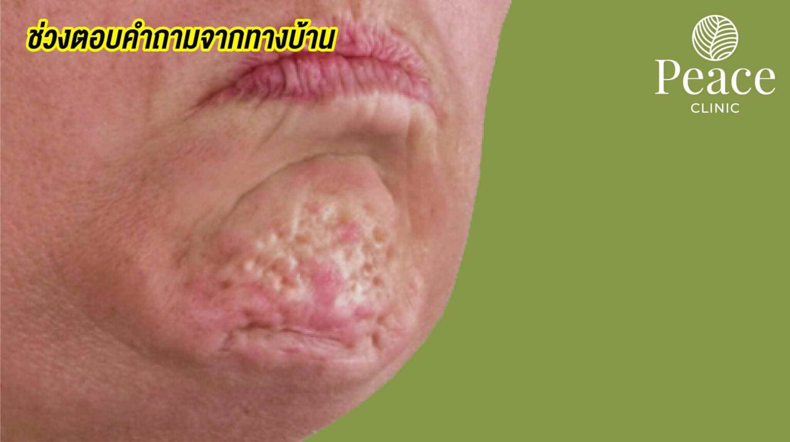 What Causes Chin Wrinkle? - Peace Clinic