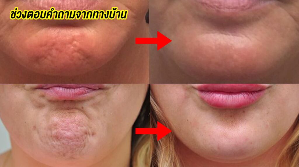 What Causes Chin Wrinkle? - Peace Clinic