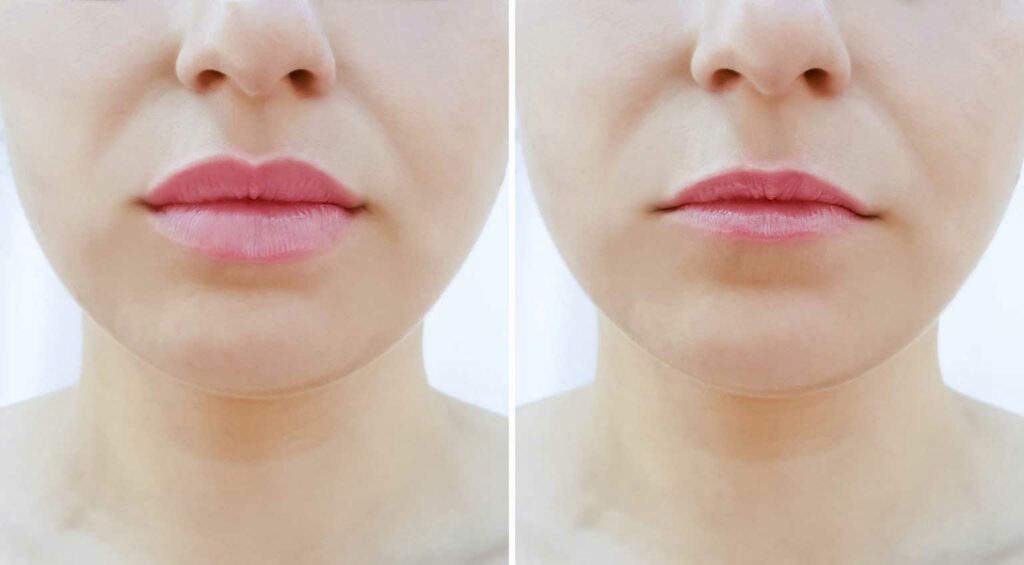 Why Do Lips Thin With Age? - Peace Clinic